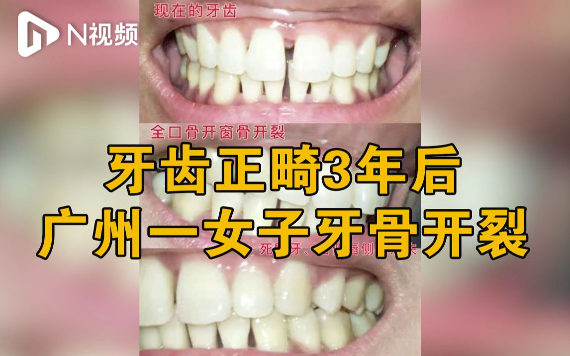 广州一女子正畸三年牙骨开裂,越秀卫健局:建议申请医疗事故鉴定