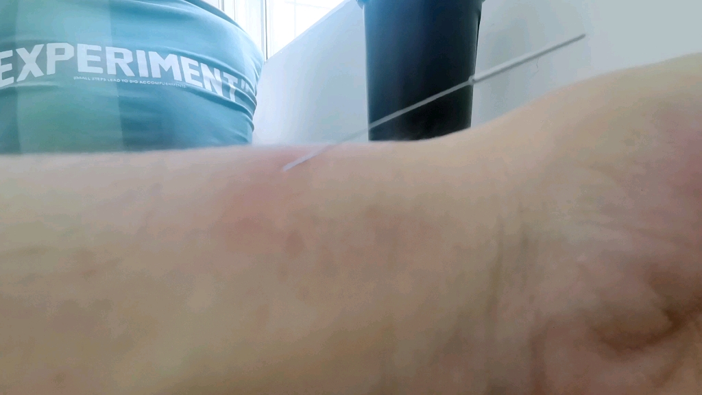 上课时咽喉不畅,针刺左侧列缺穴,行补泄手法后,皮局部皮肤出红,且伴随...