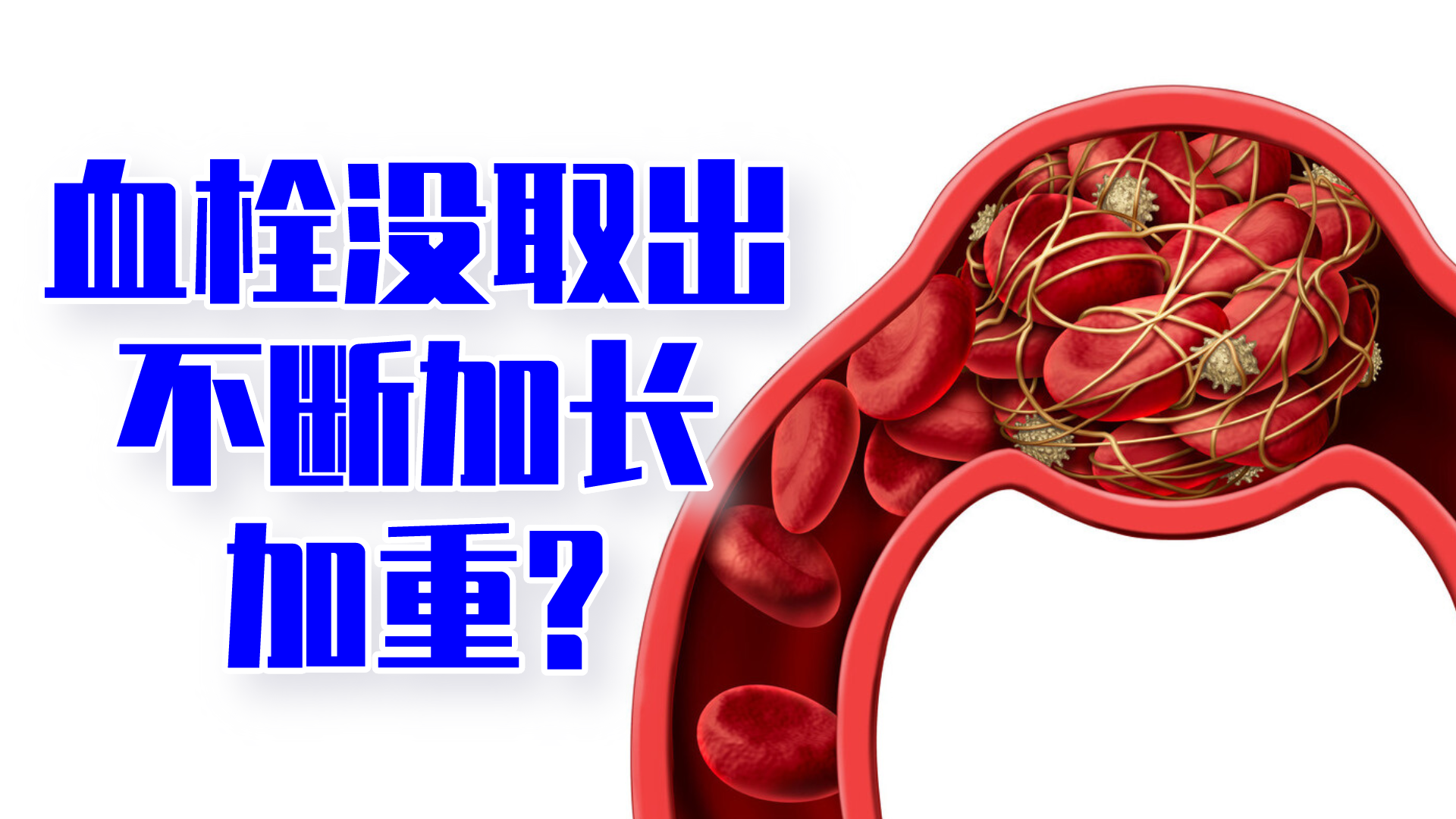 脑梗塞后血栓没取出,会不断加长加重病情?弄清原理,不再恐慌