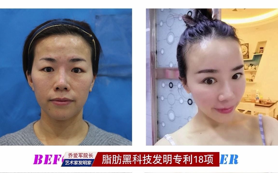 面部脂肪填充如何进行完美的美学设计?江雪,来自河北,不开刀改脸型。...