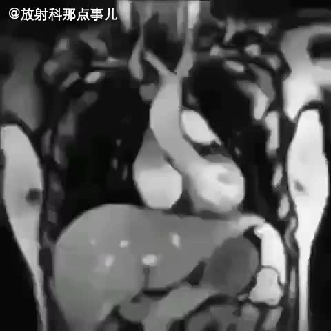 ...共振检查下的呼吸与心跳,可以动态观察心脏心房心室的收缩和舒张情况