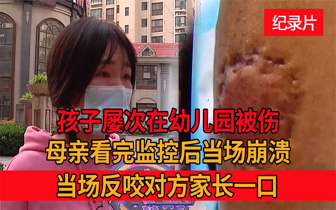孩子在幼儿园被咬伤,母亲看完监控崩溃,一气之下竟反咬对方家长