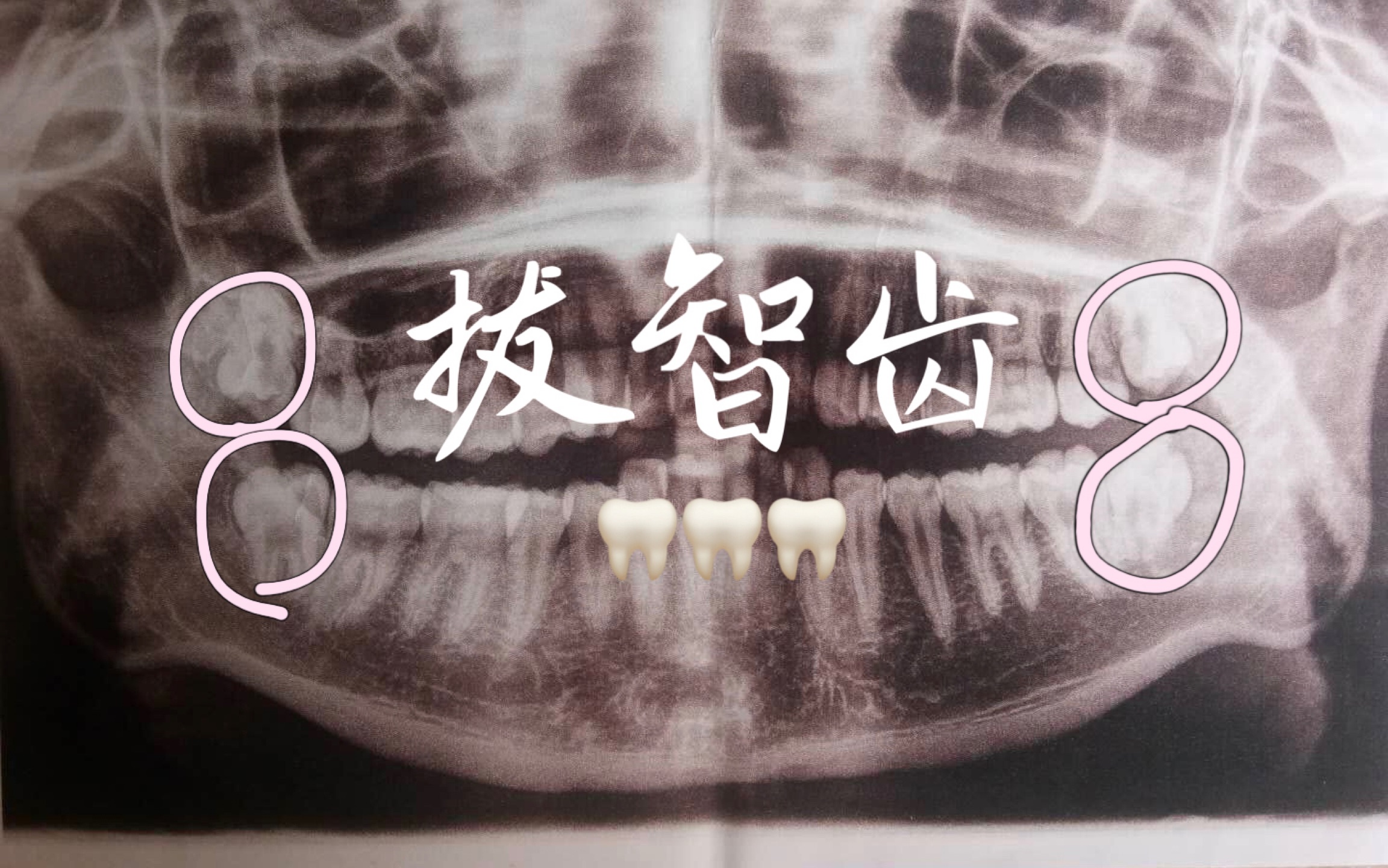 【唐芋苗的vlog】在南京市口腔第二次拔智齿|异地拔牙|学校医保