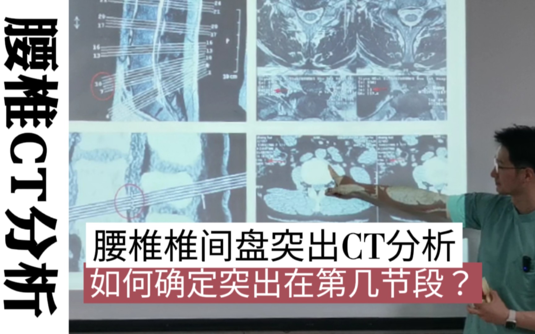 腰椎间盘突出CT分析之节段如何定位
