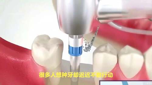 种牙前必看!4步流程全解析,轻松搞懂种植牙不再迷茫