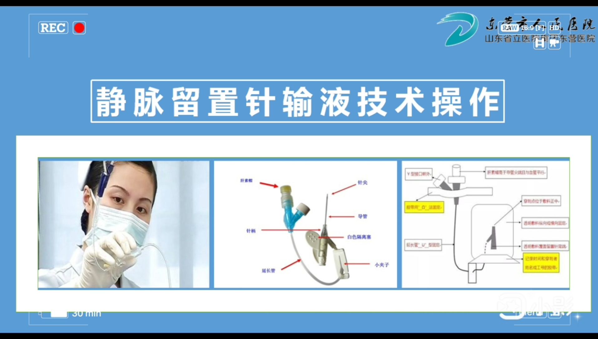 静脉留置针输液技术操作