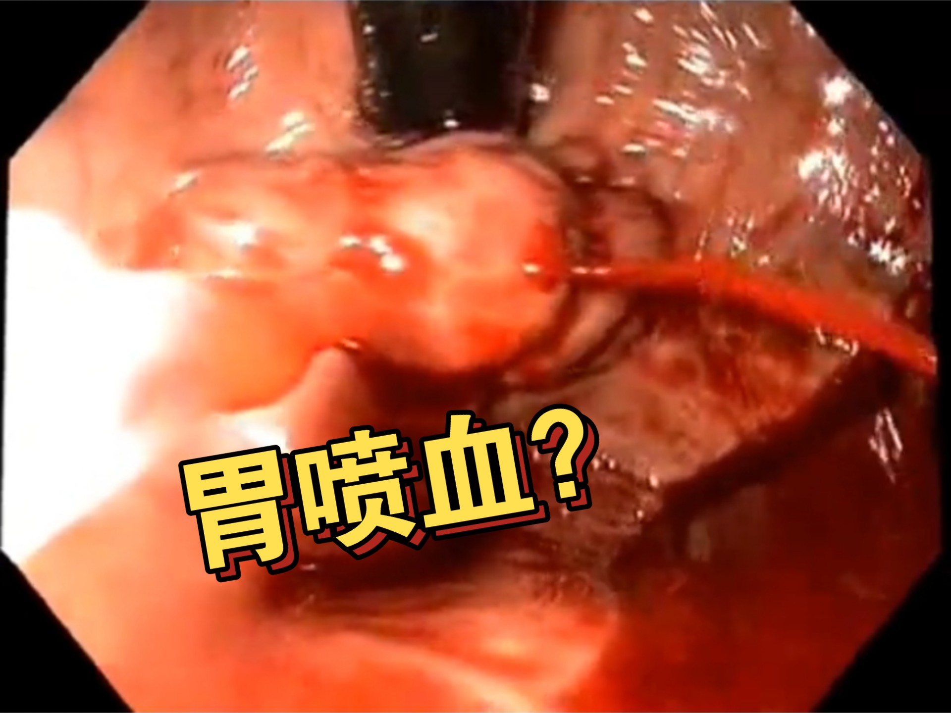 胃出血后内镜下止血