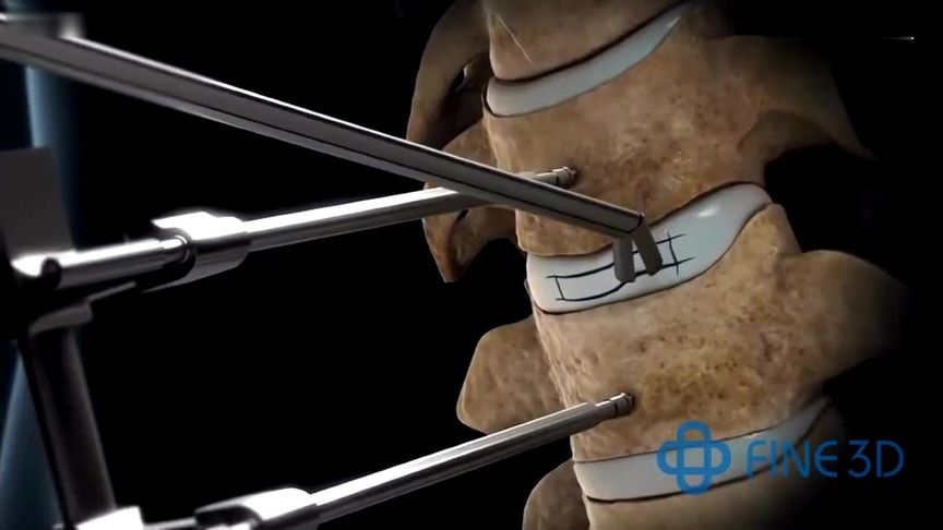 2分钟看懂腰椎间盘突出手术是怎么做的-3D动画演示详细解析