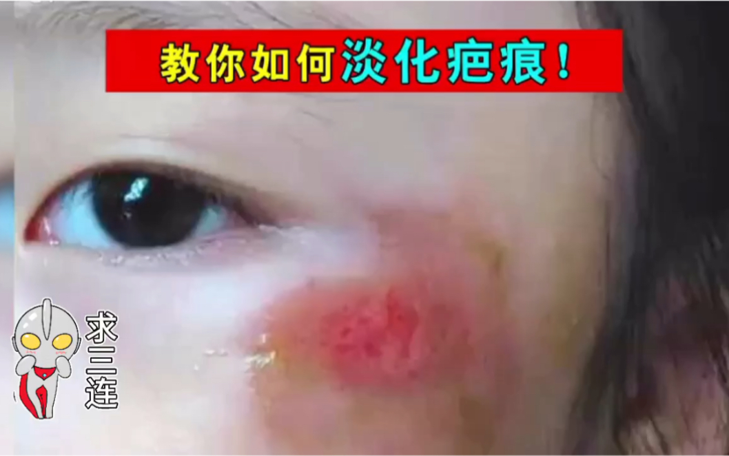 脸上有疤痕怎么办?如何消除呢?