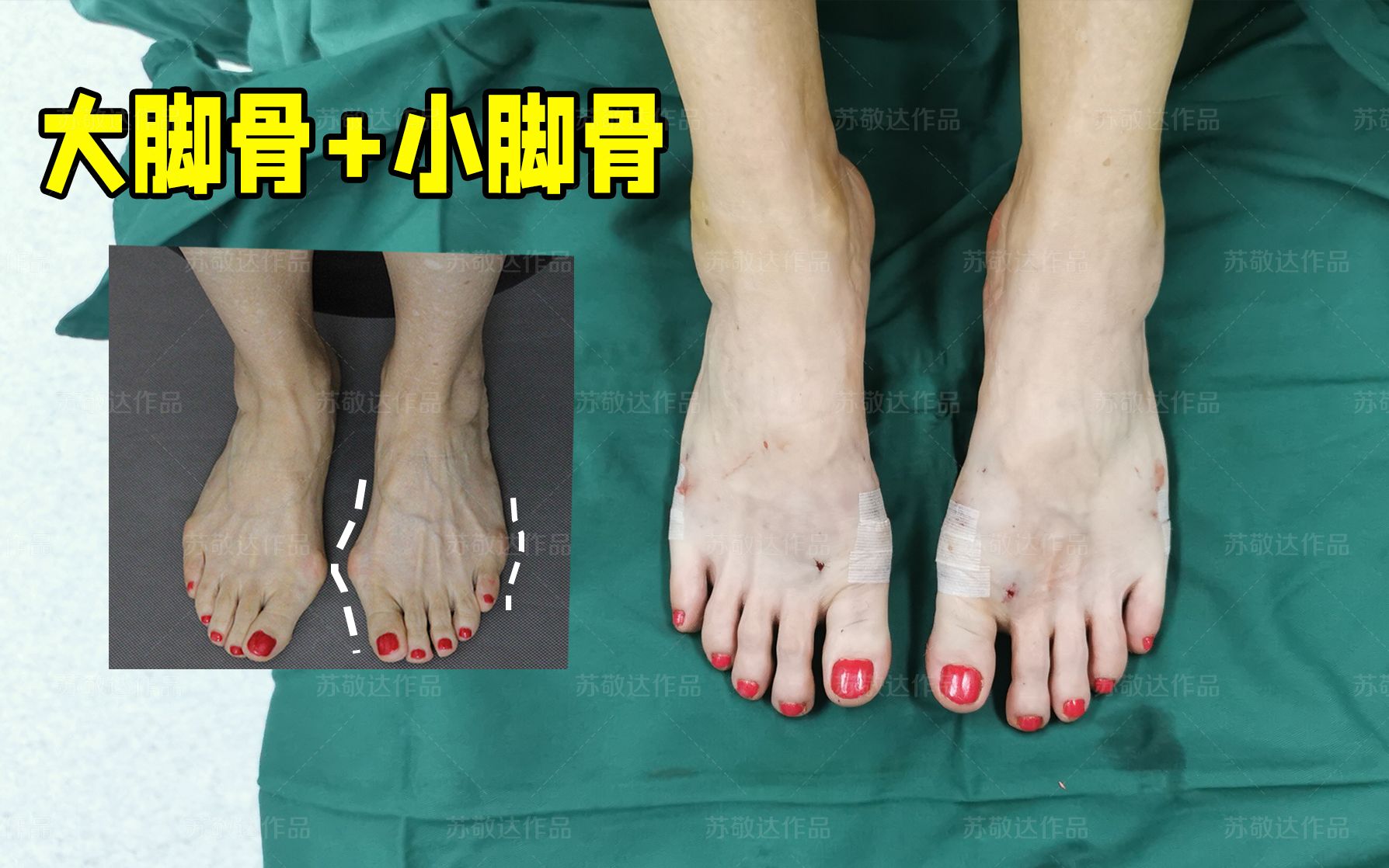 北京苏敬达医生:大脚骨拇外翻+小脚骨,鞋码37变39,又宽又疼又丑,决定...