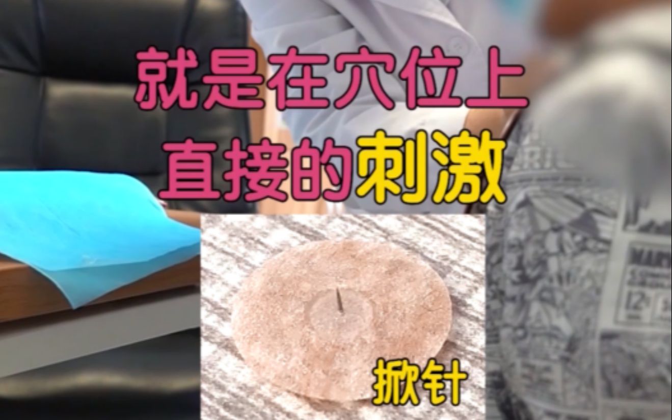 王素梅医生:改良揿针按摩穴位减轻疼痛