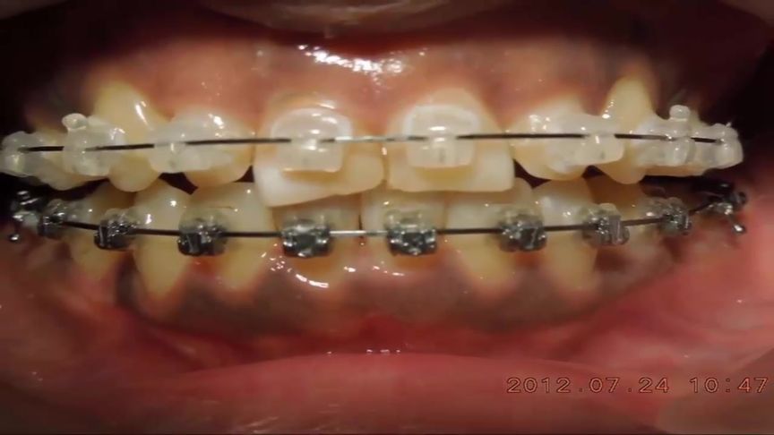畸形生长的牙齿正畸过程,看完好震撼!