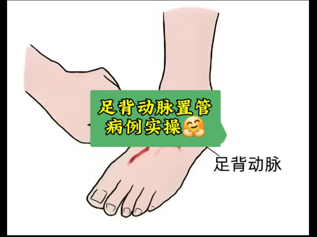 足背动脉置管病例实操ߤ