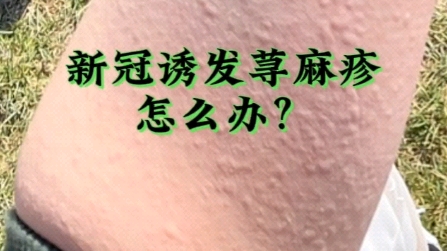 感染新冠病毒,诱发荨麻疹,怎么办?