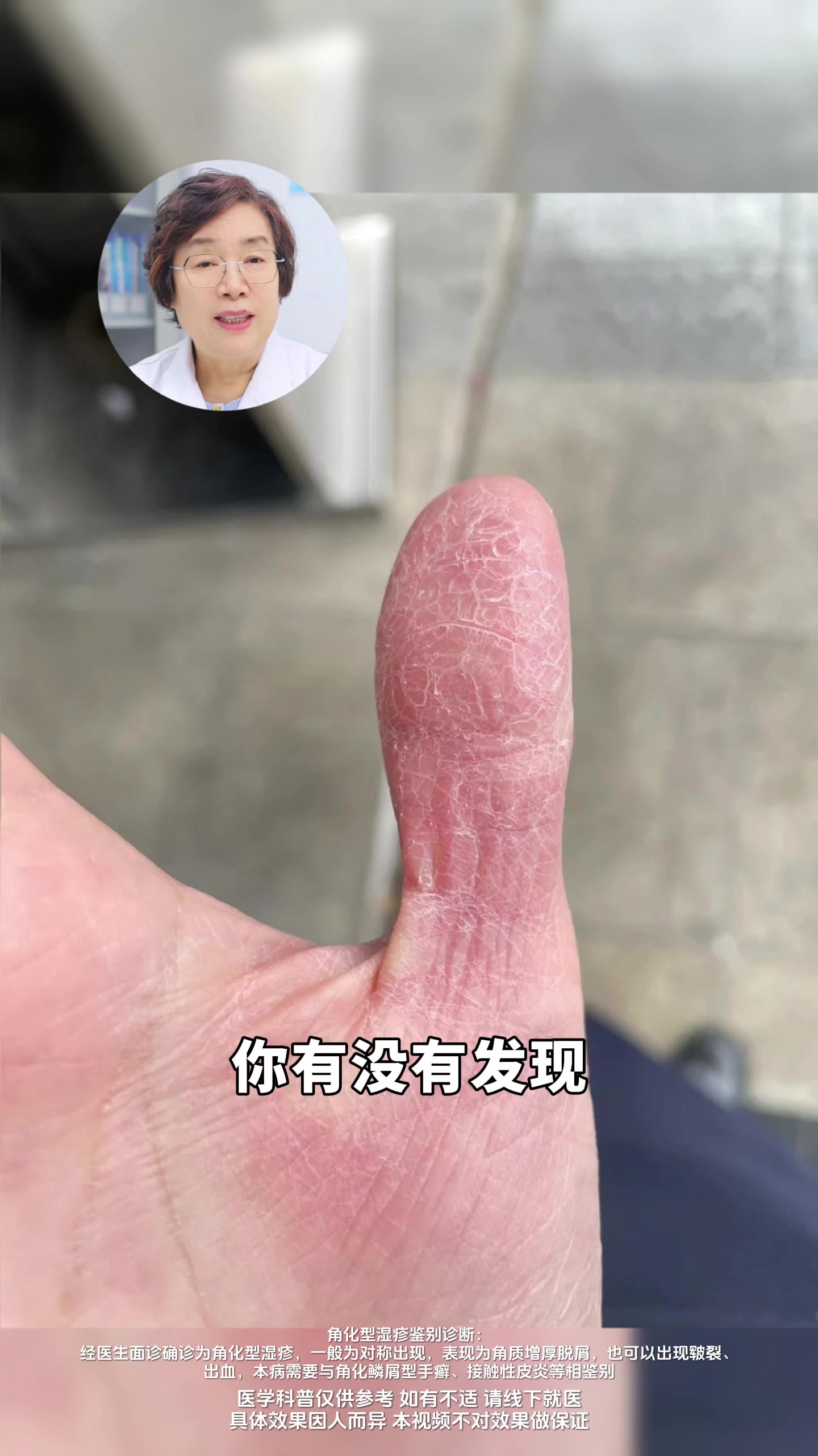 一到冬天,为什么很多女性的手干燥裂口?#健康科普 #角化型湿疹 #家庭...