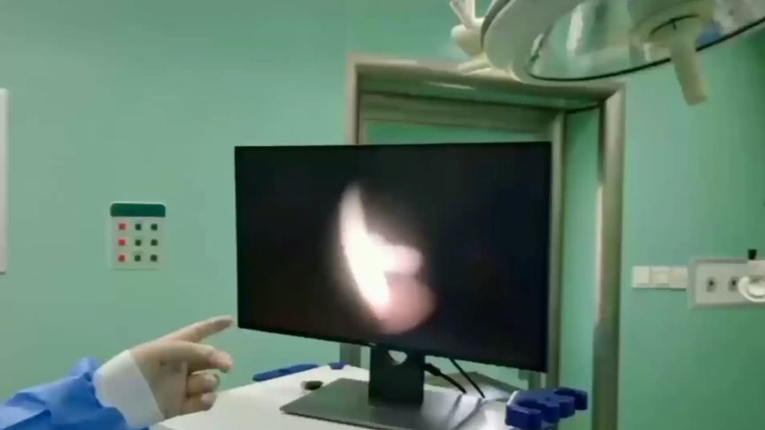 输尿管结石所致尿源性脓毒血症