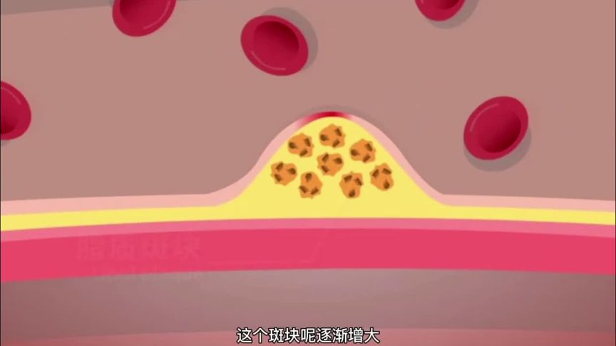 你了解动脉硬化的成因吗?#科普健康 #动画#动脉硬化