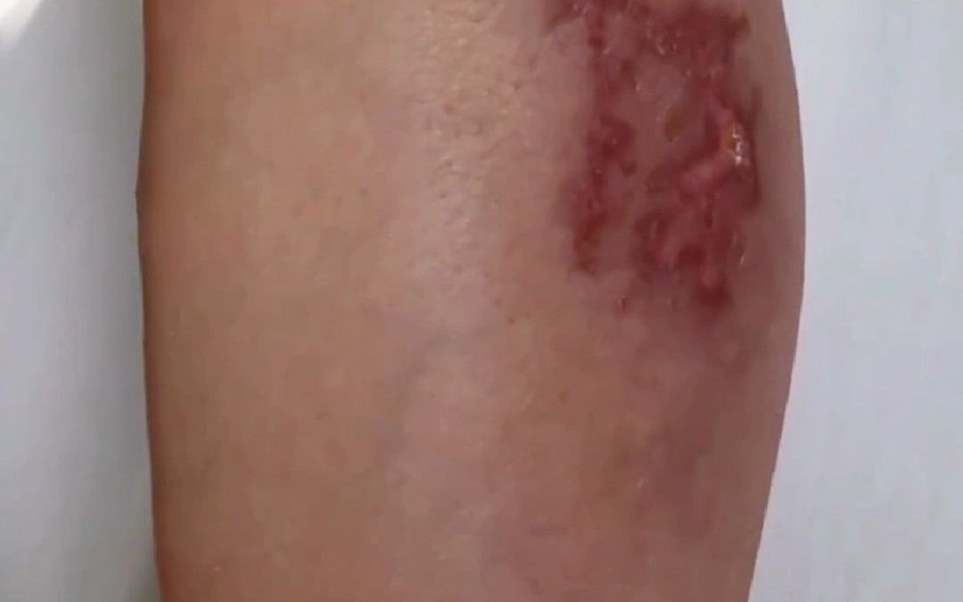 艾灸不当导致深度烧伤,伤后疤痕增生!