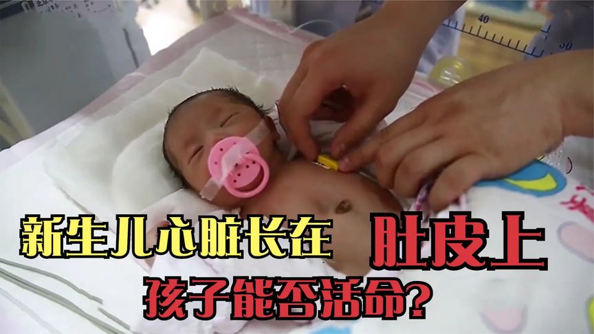 新生儿心脏长在肚皮上,中国医生紧急抢救,竟让心跳停住1小时!