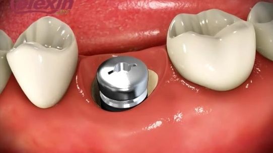 微创种植牙手术全过程