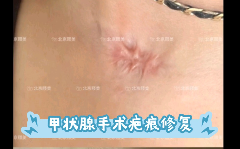 甲状腺手术疤痕修复