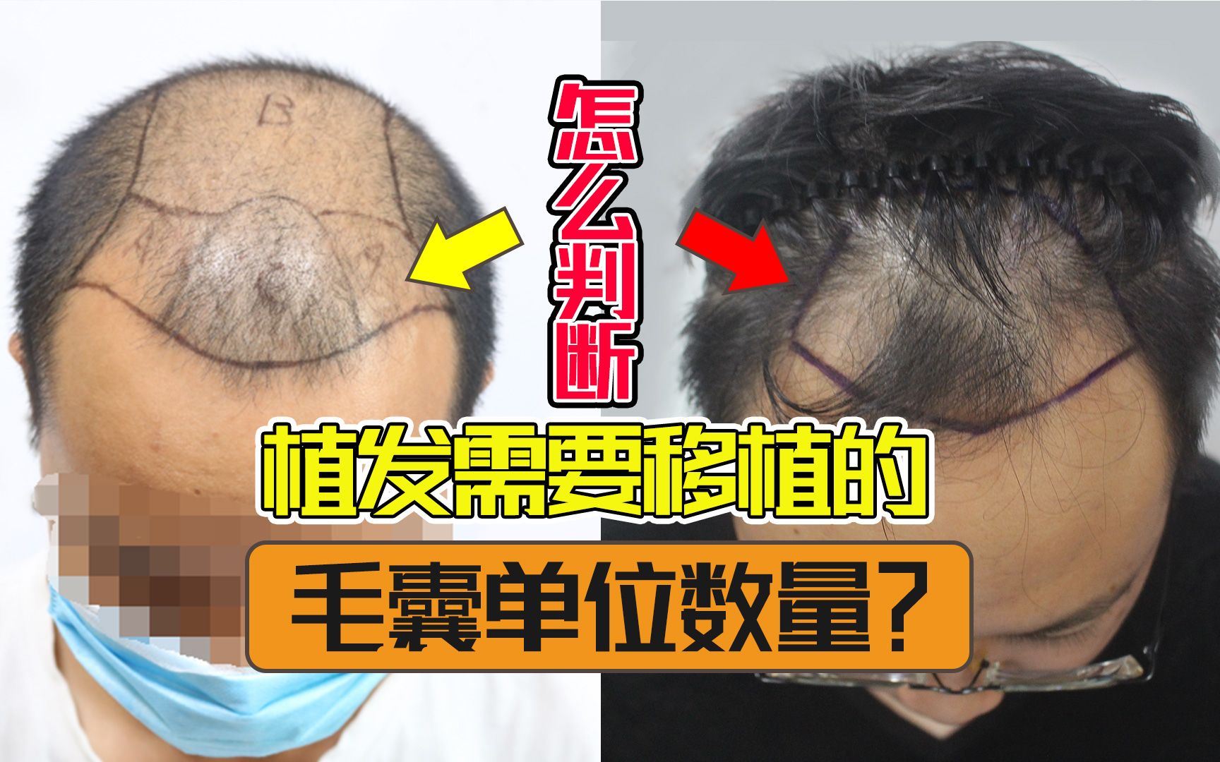 怎么判断植发需要移植的毛囊单位数量?