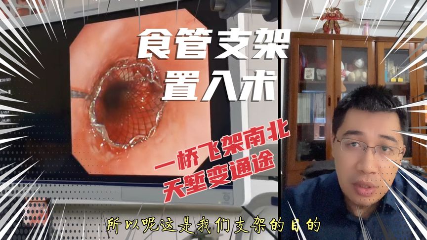 让狭窄再度通畅的食管支架置入术,解决吃饭问题,有尊严的活着!