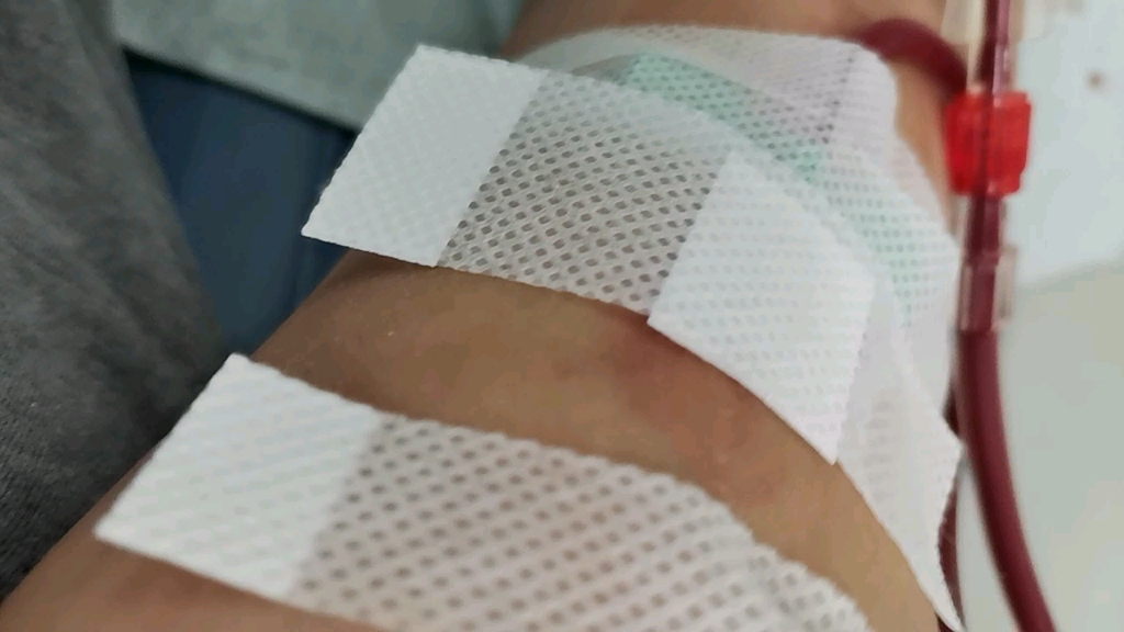 2021.12.8透析打卡 今天是新来的小伙子扎针的