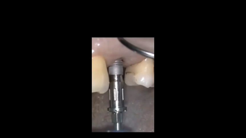 高清视频口腔 种植牙 微创手术