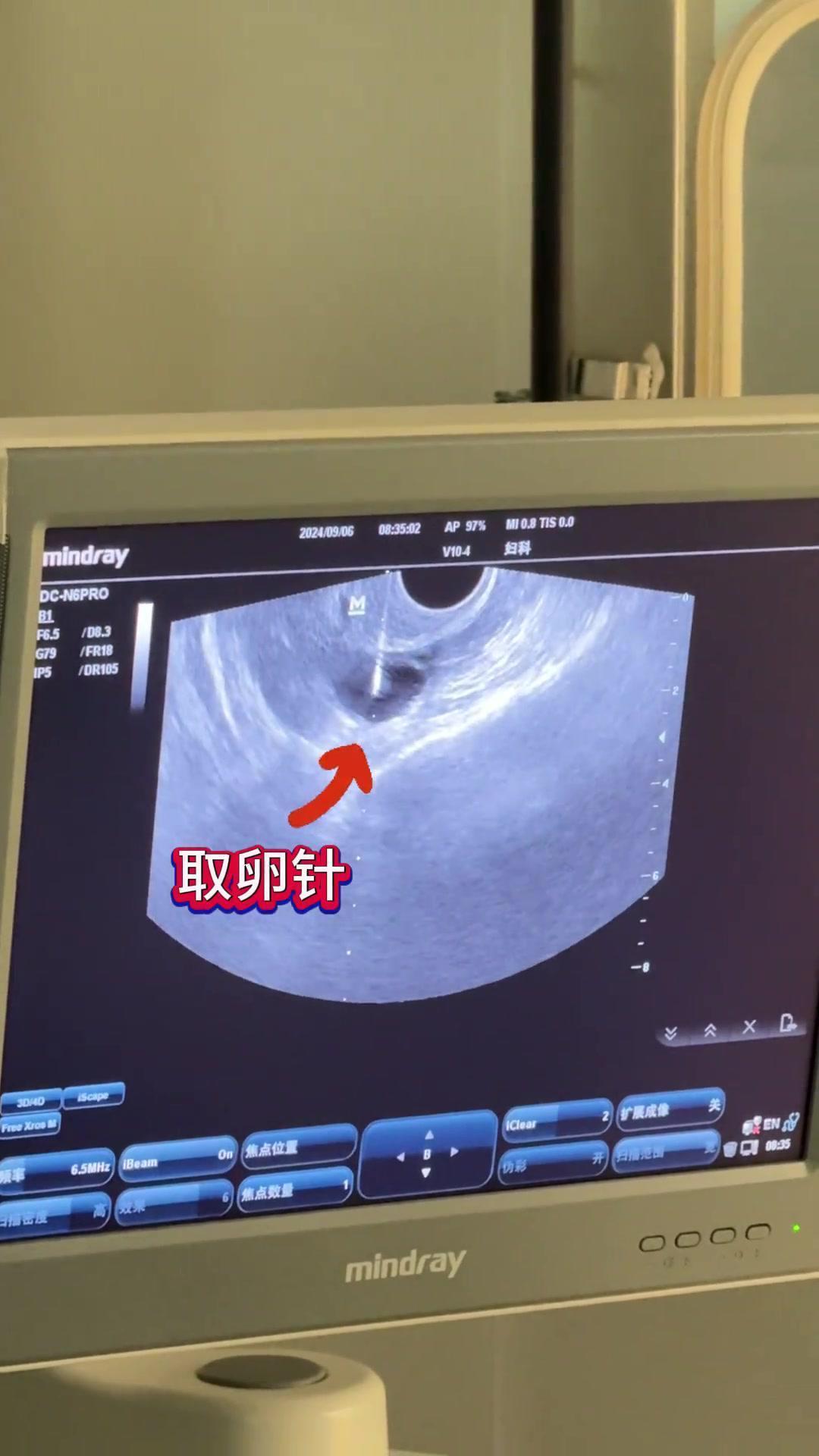 取卵手术是怎样的?今天带大家了解女性取卵全过程!#医学科普#女性健康#取卵
