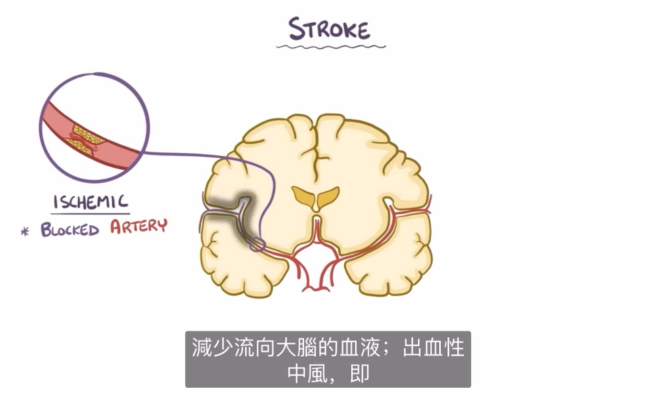 ...(脑血栓形成+脑栓塞) 出血性脑卒中|脑梗死定义临床表现诊断治疗及...