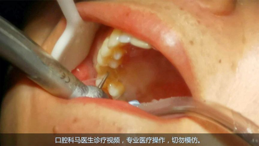 根管治疗步骤——开髓术和失活术,24分钟