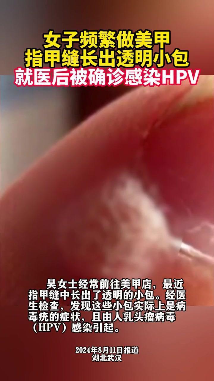 武汉市第一医院皮肤科主治医师肖婧提醒,由于市场上美甲店的质量...