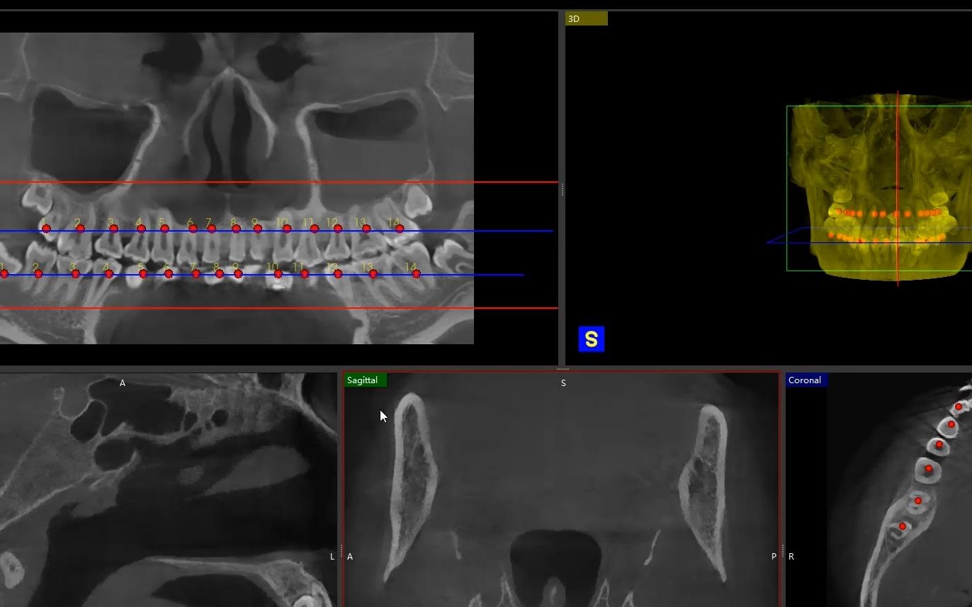 案例介绍——牙科CT三维