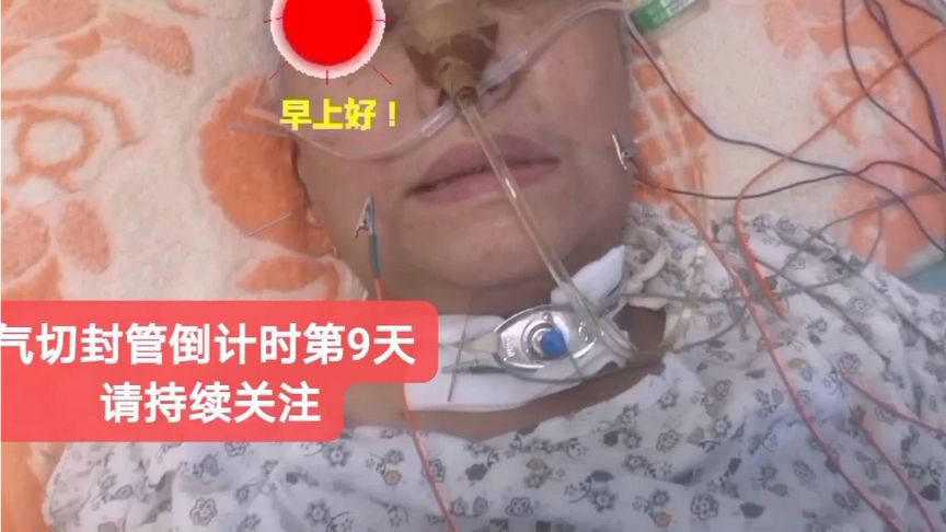 气切封管倒计时第9天,请持续关注。