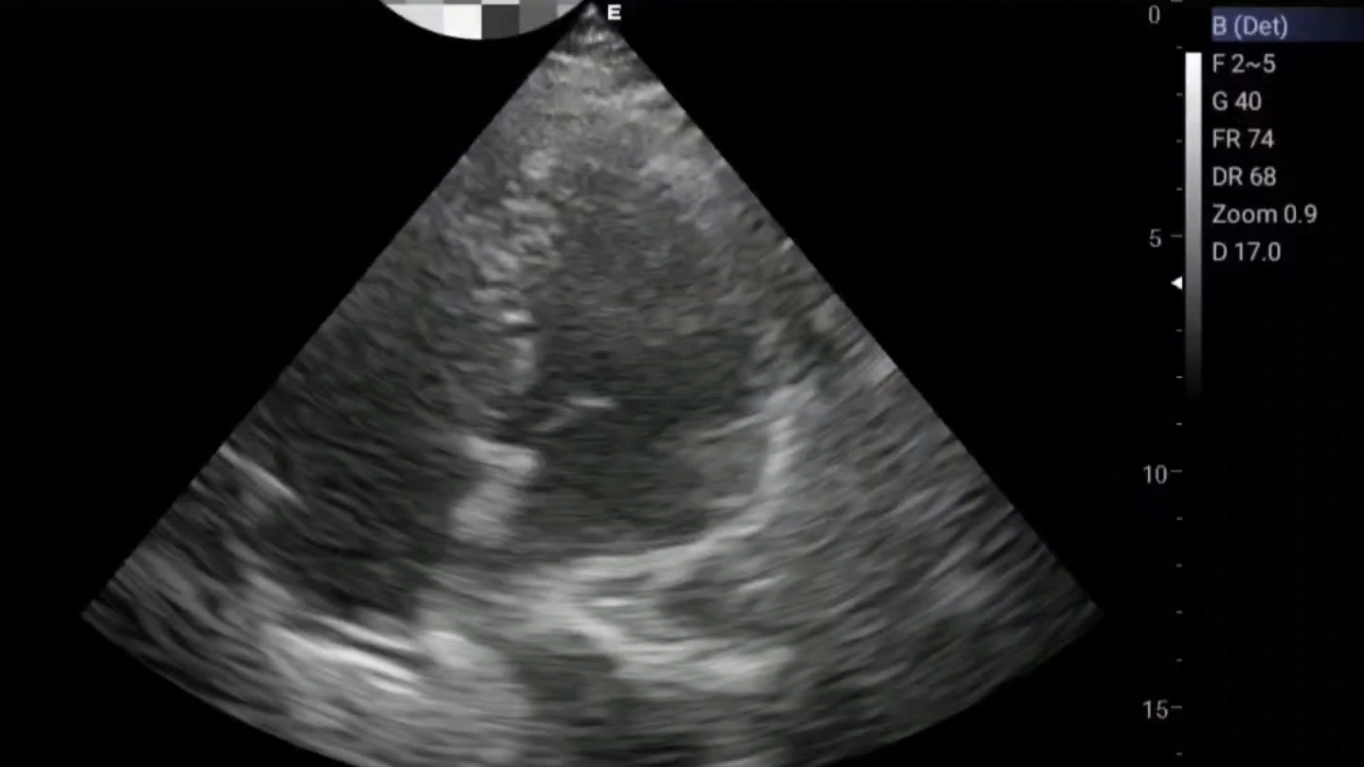 超声下的心室颤动