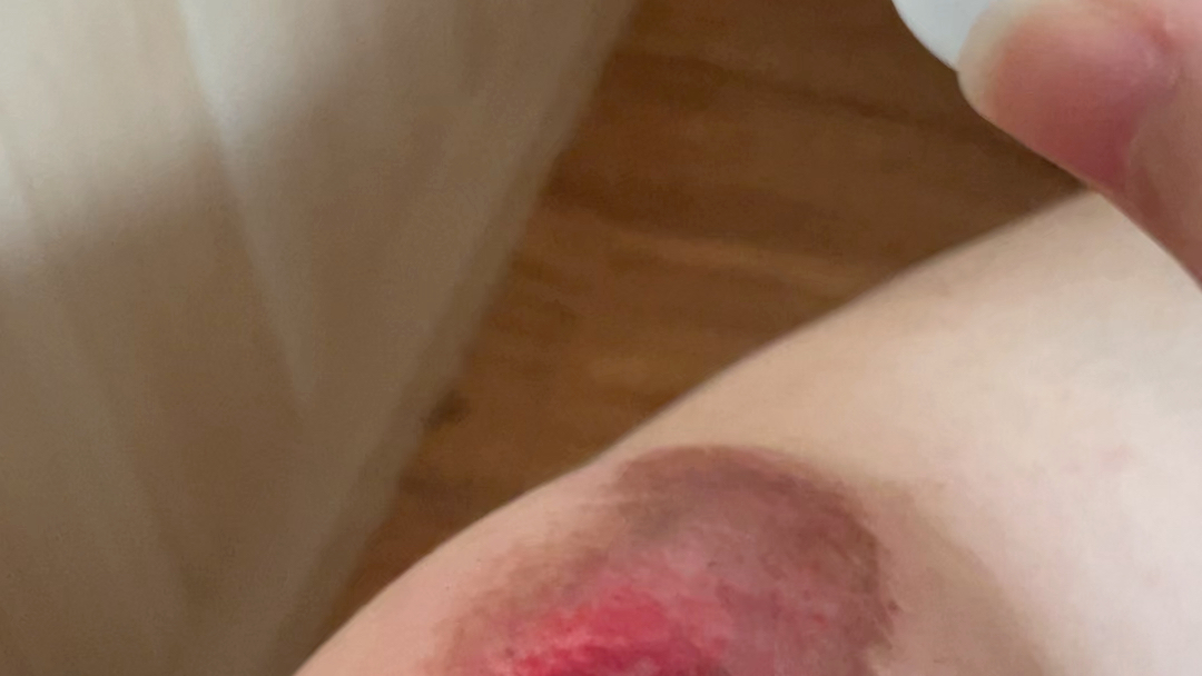 双氧水处理伤口,酸爽啊啊啊啊啊啊啊啊啊!