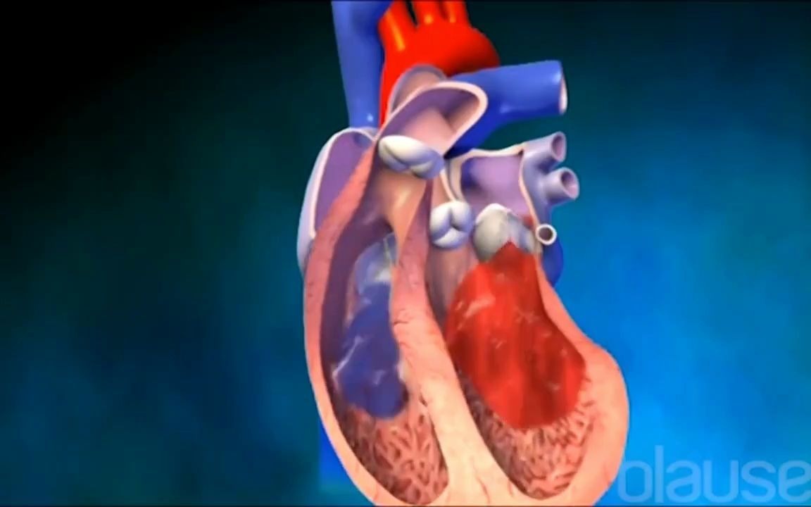 主动脉瓣置换术动画(机械瓣、生物瓣)
