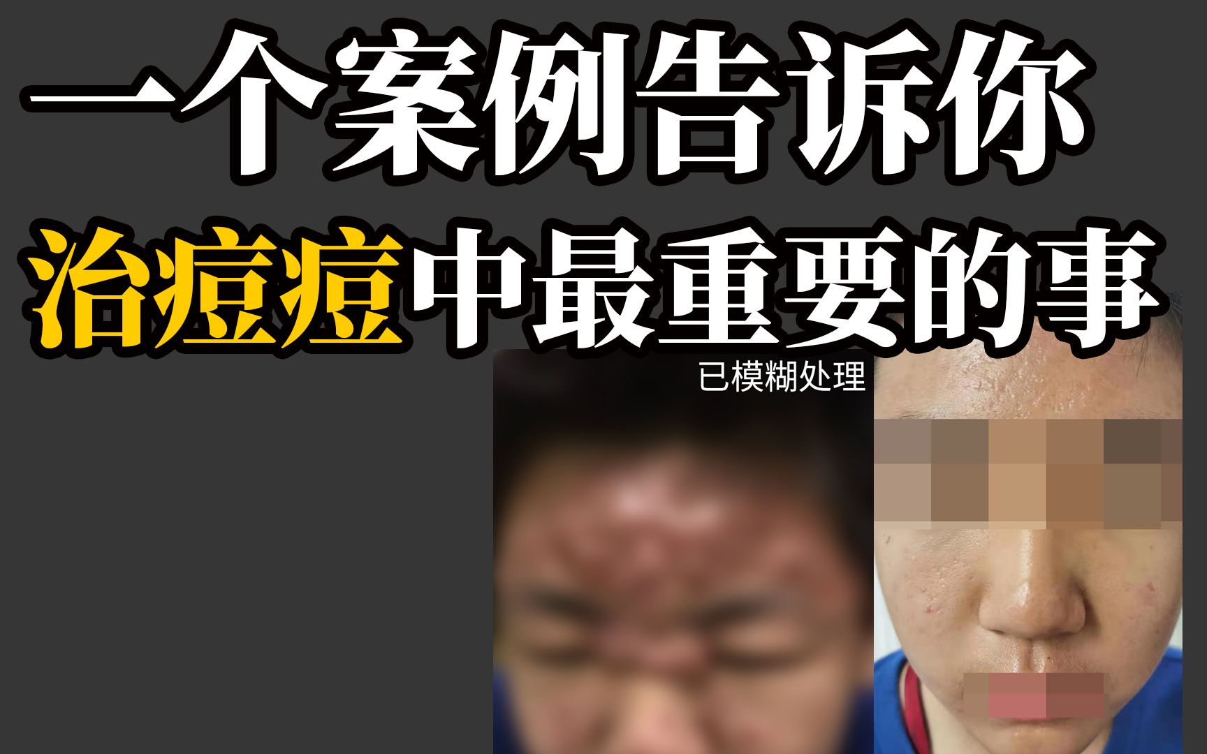 【皮肤科】痘痘治疗中什么最重要?一个皮肤科医生的肺腑之言