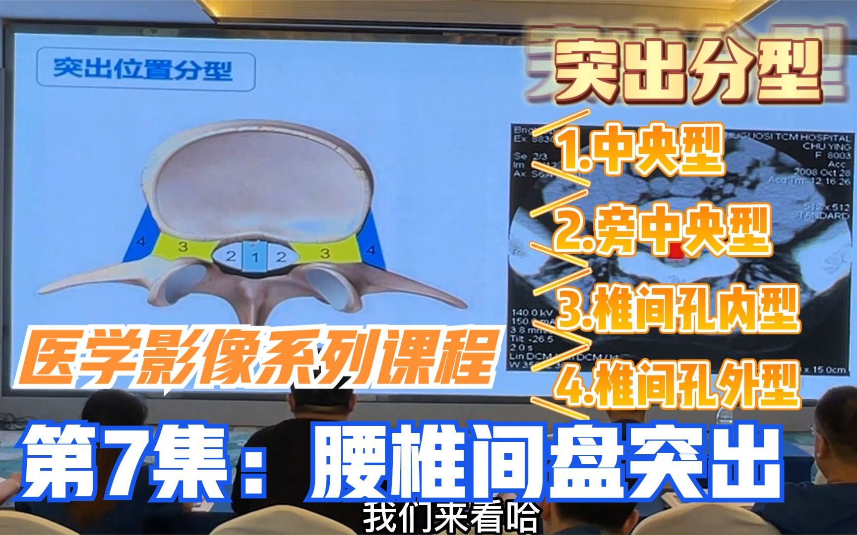 4种腰椎间盘突出类型,教你用CT做完整诊疗思路,视频最后有建议