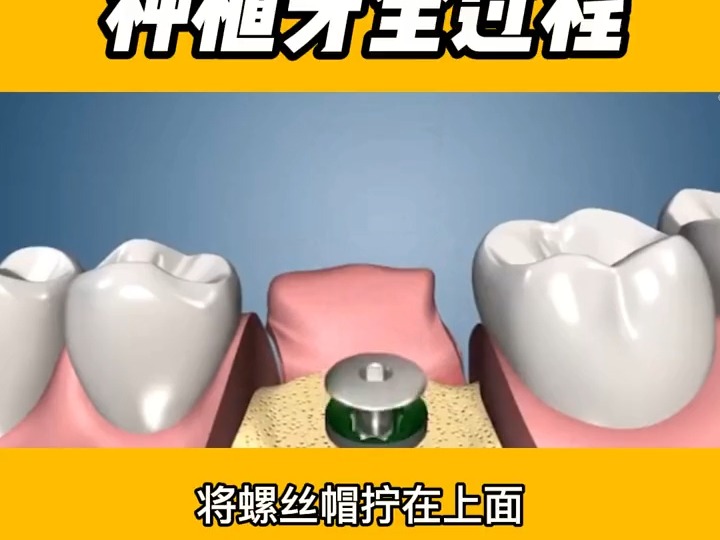 3D动画演示 种植牙全过程