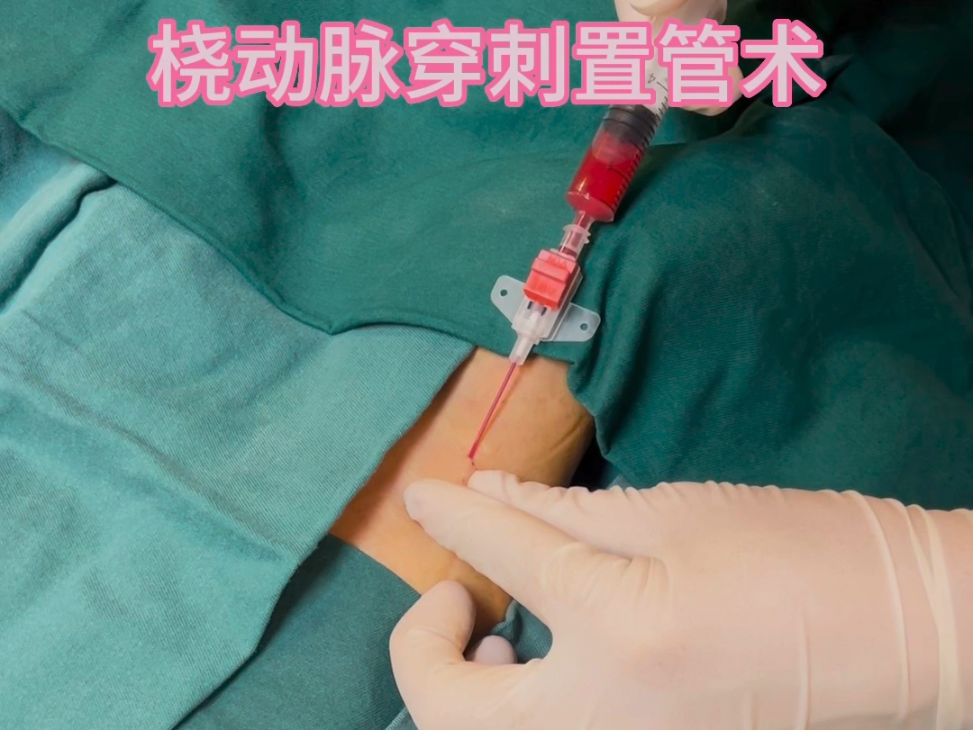 桡动脉穿刺置管术