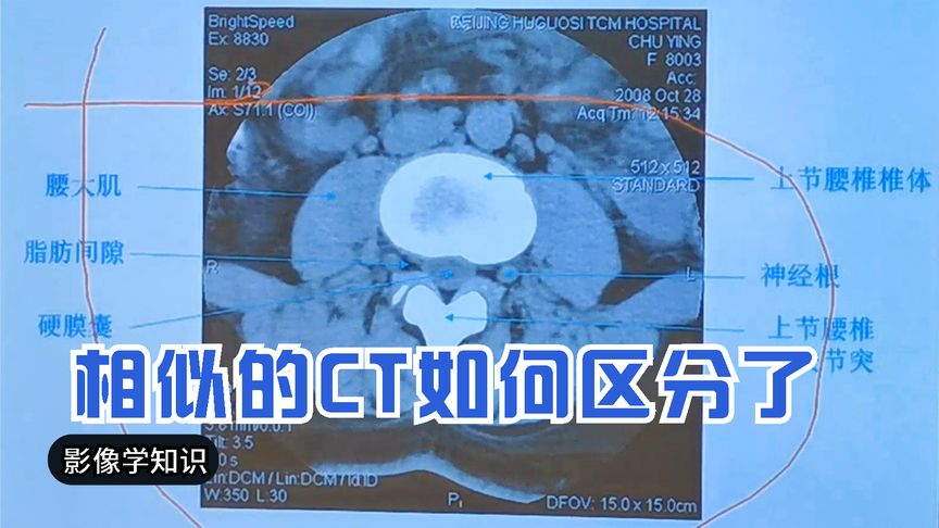 CT读片技巧,相似的横断面如何区分,教你分清定位图和定位线