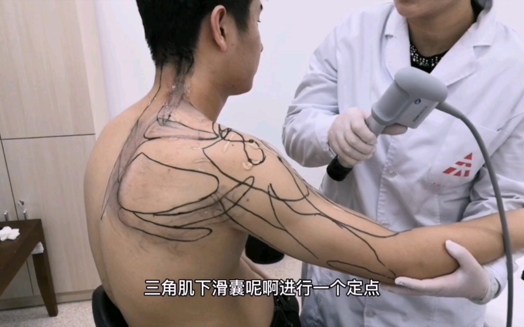 颈椎周围的放散式冲击波治疗(三)