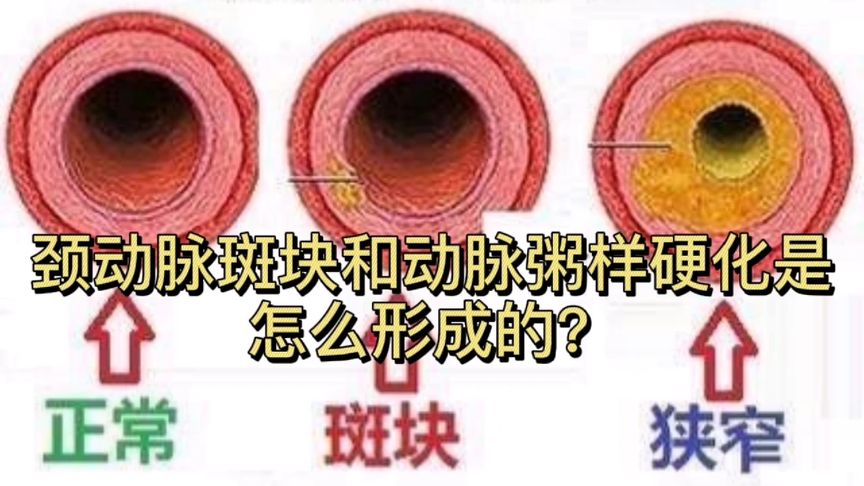 颈动脉斑块和动脉粥样硬化是怎么形成的?医生这样说,你就明白了