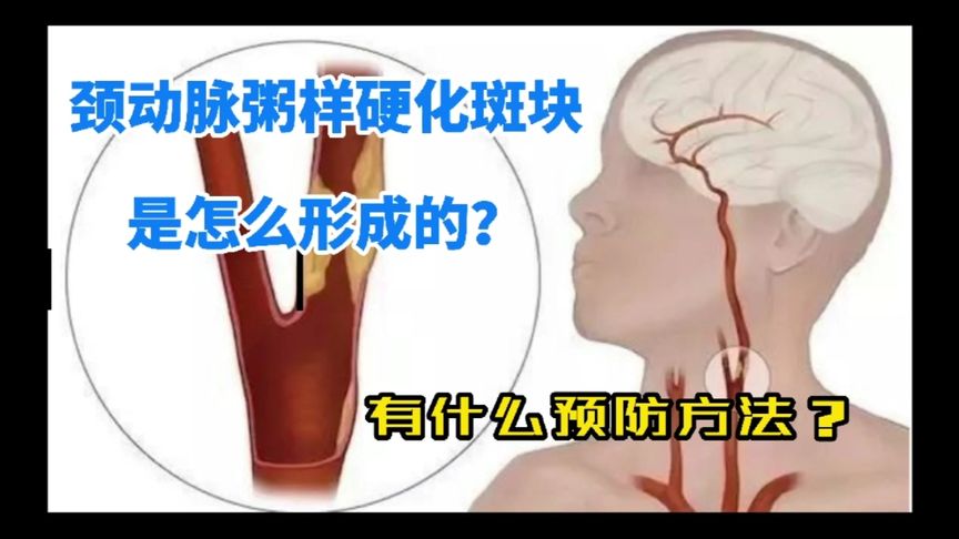 颈动脉粥样硬化斑块是怎么形成的?有什么预防方法?
