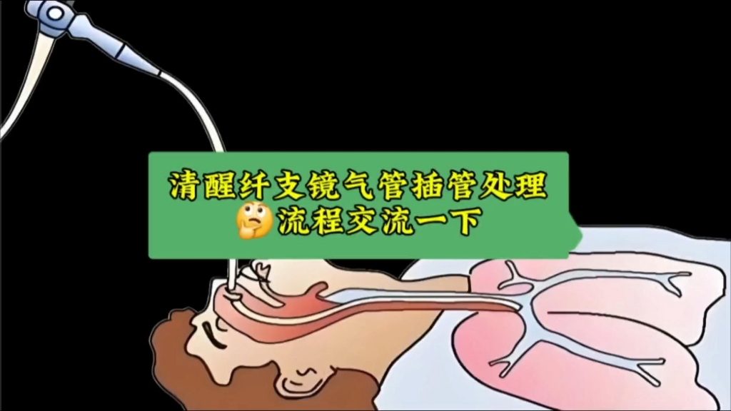 清醒纤支镜气管插管处理流程交流一下仅供参考