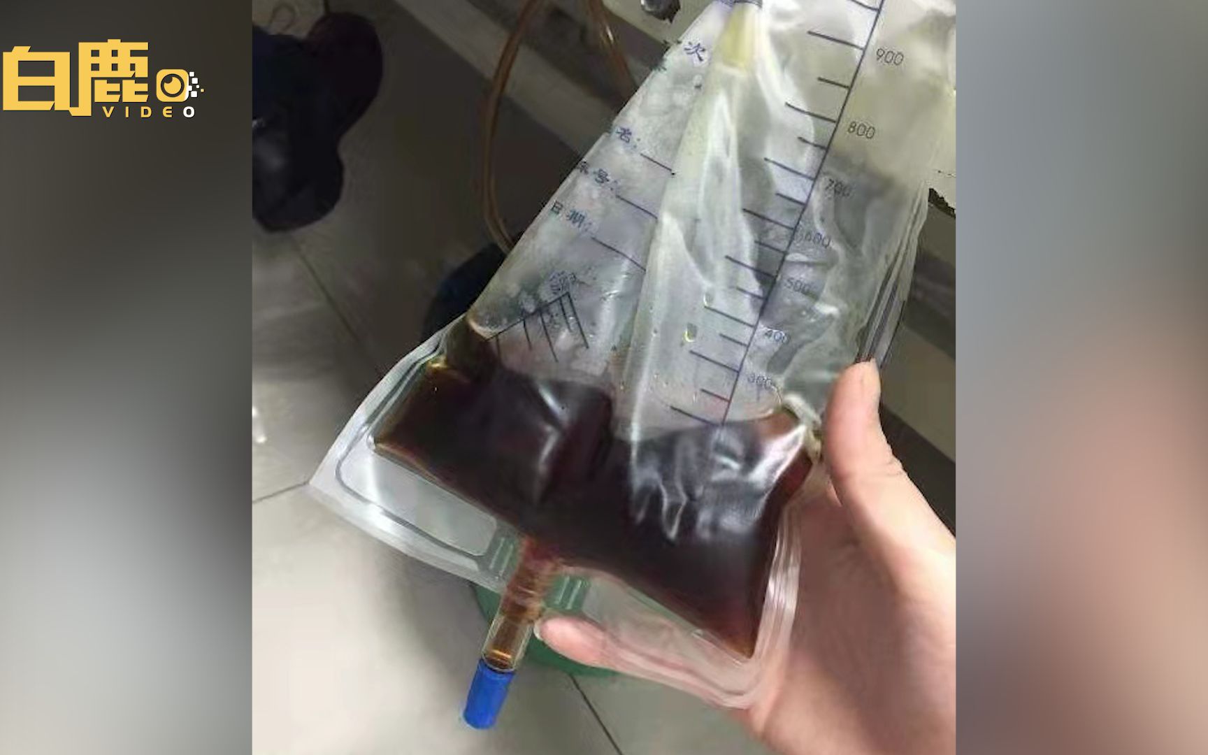 小伙举哑铃深蹲30分钟3天后住进icu,日花费1万做血液净化治疗