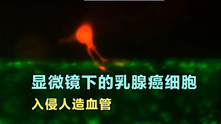 你知道癌细胞是如何入侵血管的吗?