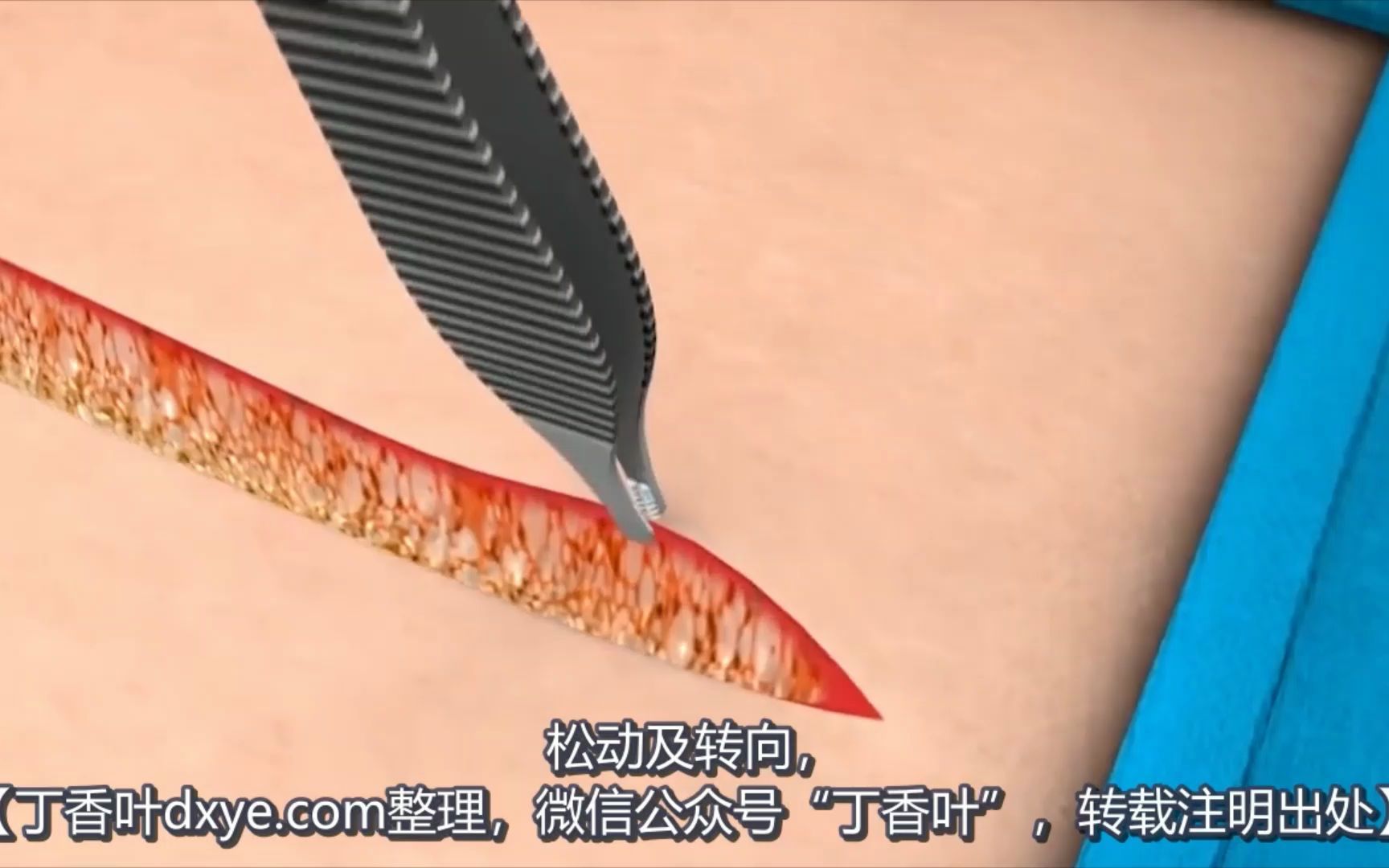 [医学视频]缝合技巧与手法